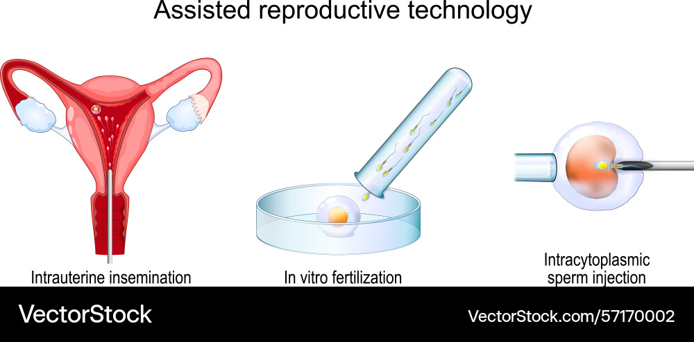 Iui Vector Images (85)