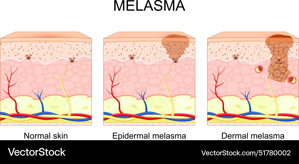Melasma types chloasma faciei cross section Vector Image