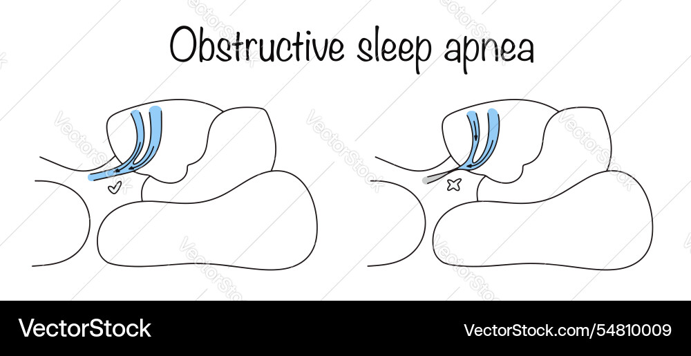 Obstructive sleep apnea Royalty Free Vector Image