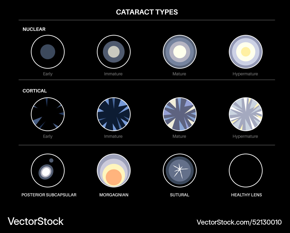 Cataract eye disease Royalty Free Vector Image