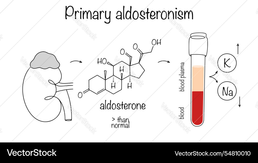 Primary aldosteronism Royalty Free Vector Image