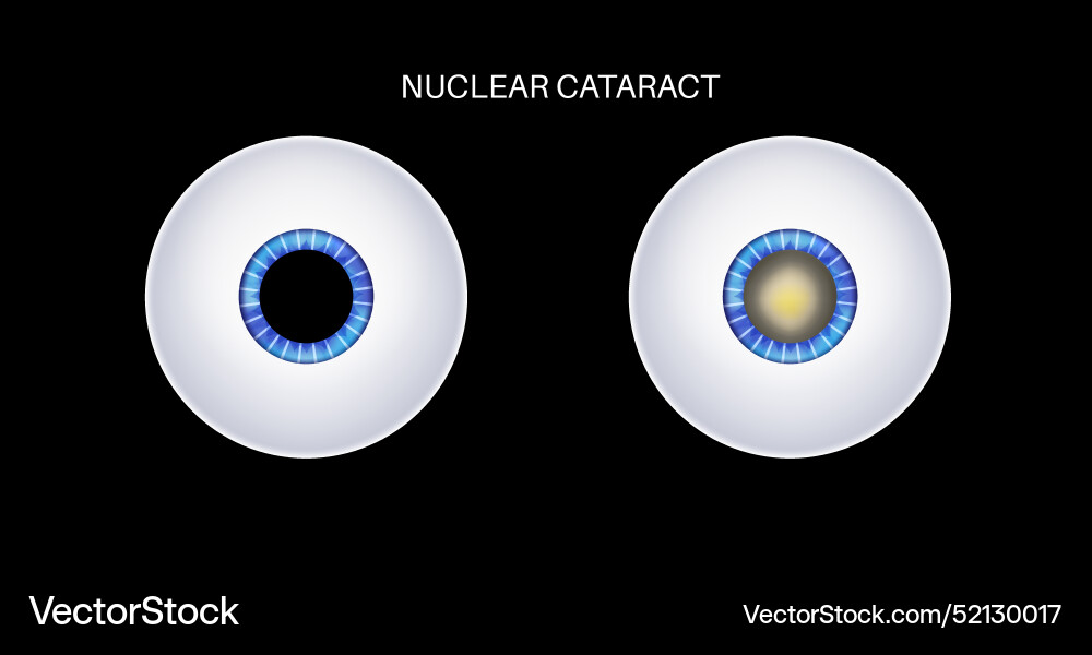 Cataract eye disease Royalty Free Vector Image