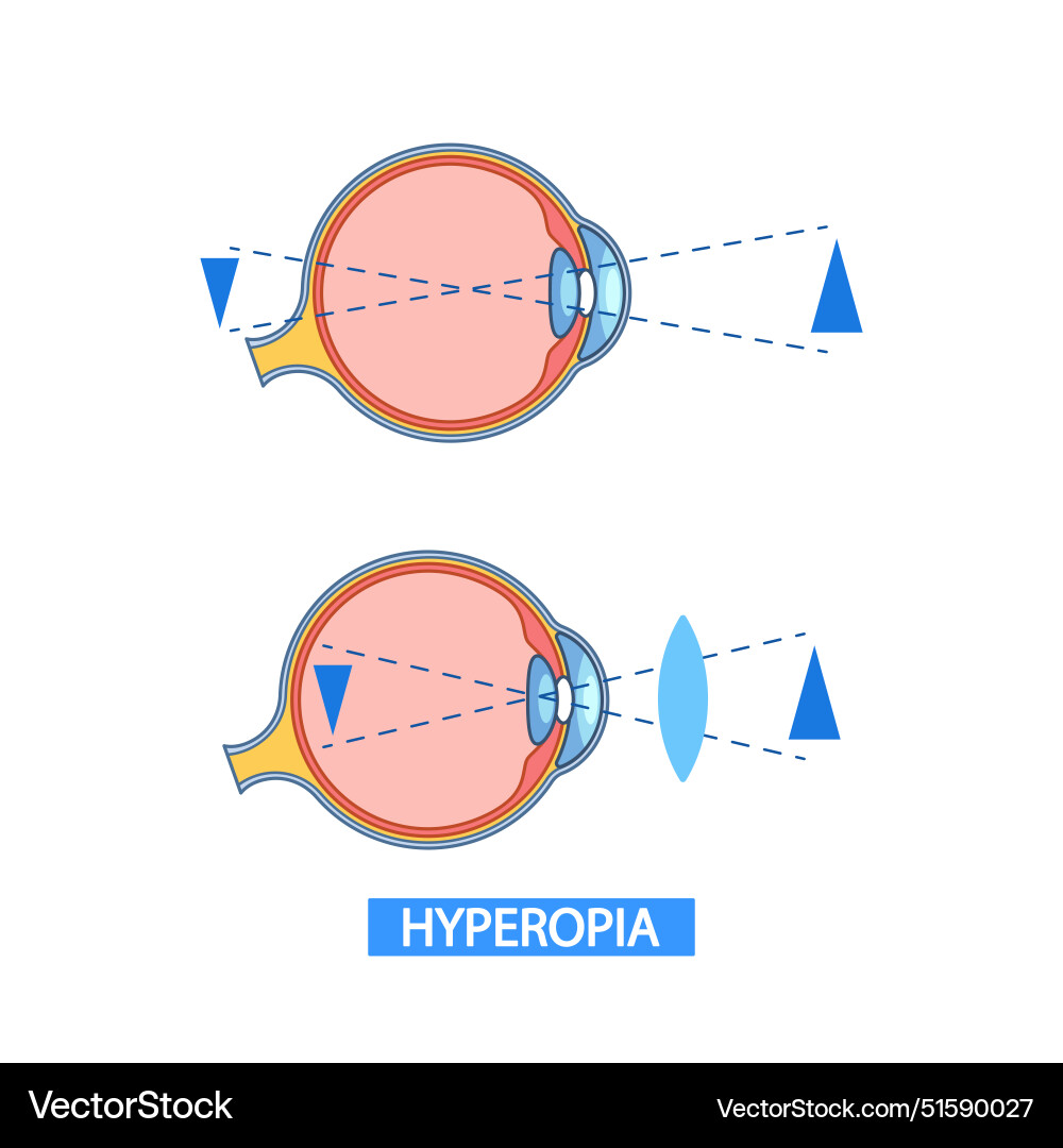 Informative infographic depicting hyperopia Vector Image