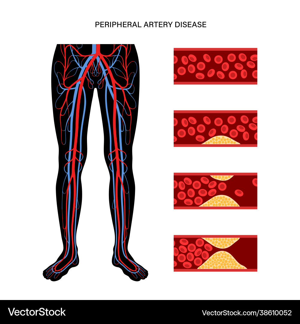 Peripheral artery disease Royalty Free Vector Image