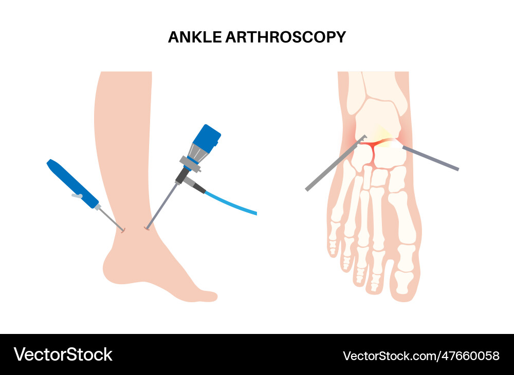 Ankle Arthroscopy Surgery Royalty Free Vector Image