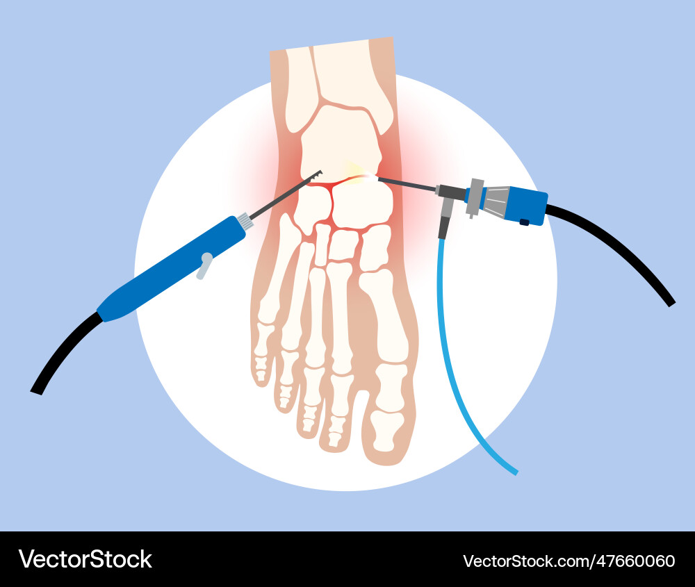 Ankle arthroscopy poster Royalty Free Vector Image