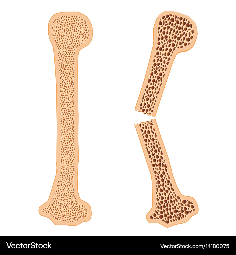 Healthy bone and broken with osteoporosis Vector Image