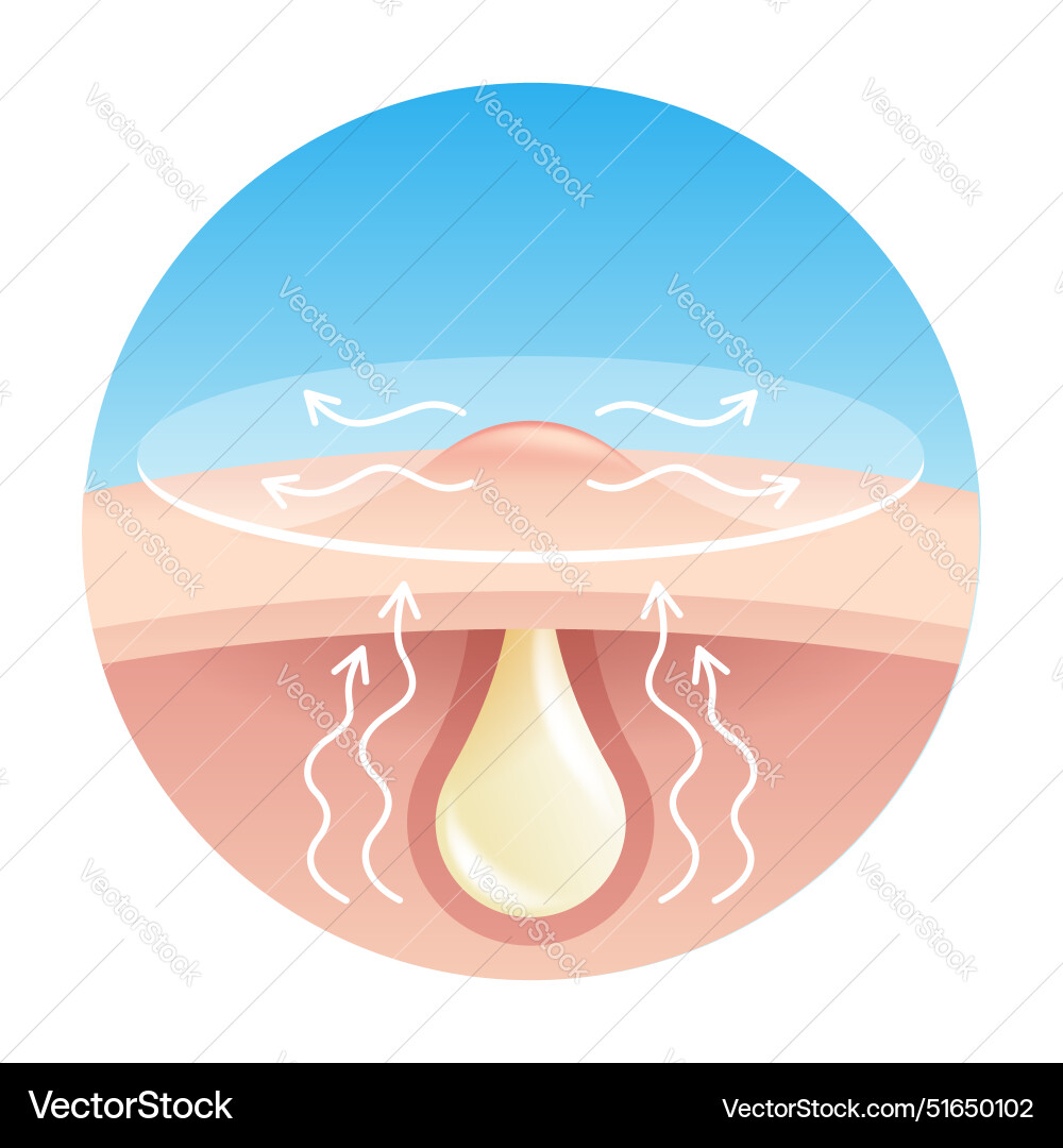 Acne pimple patch - pus absorbing Royalty Free Vector Image