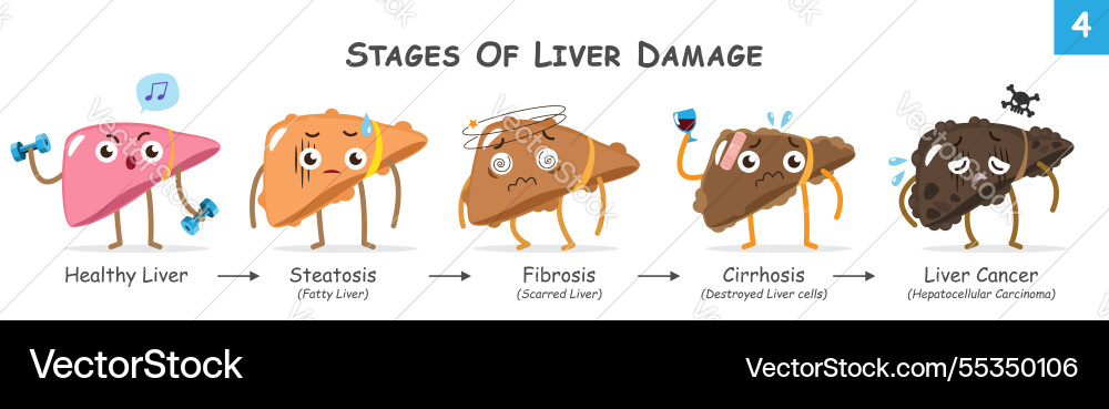 Liver Damage Stages - Cartoon Collection Vector Image