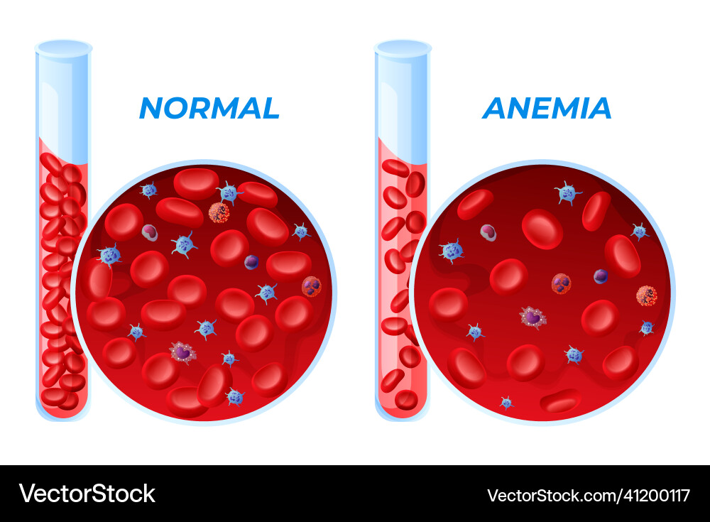 Iron deficiency anemia and normal set Royalty Free Vector