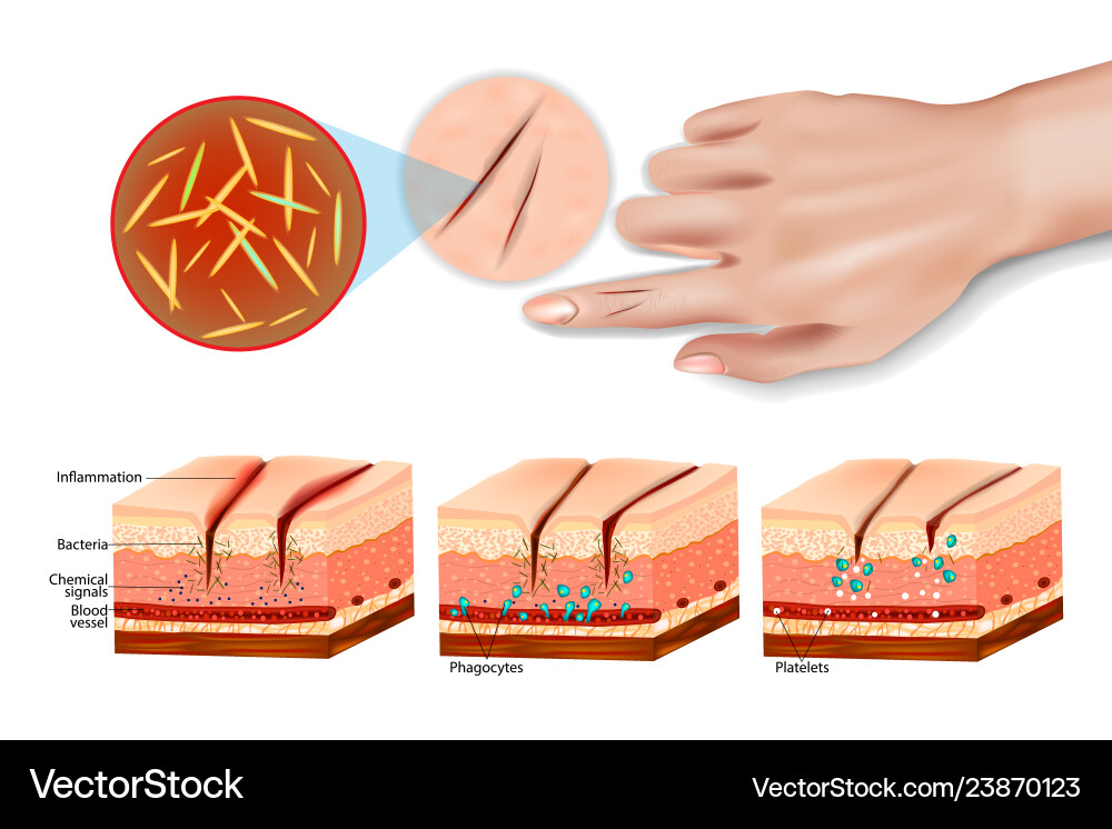 Tissue injury and inflammation Royalty Free Vector Image