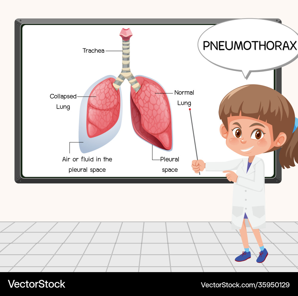 Young scientist explain pneumothorax in front Vector Image