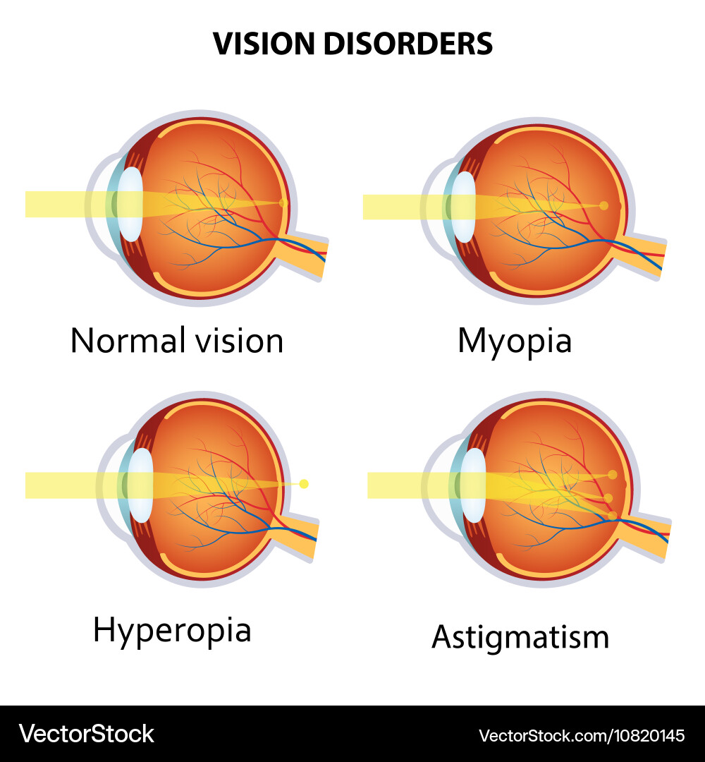 Common vision disorders Royalty Free Vector Image