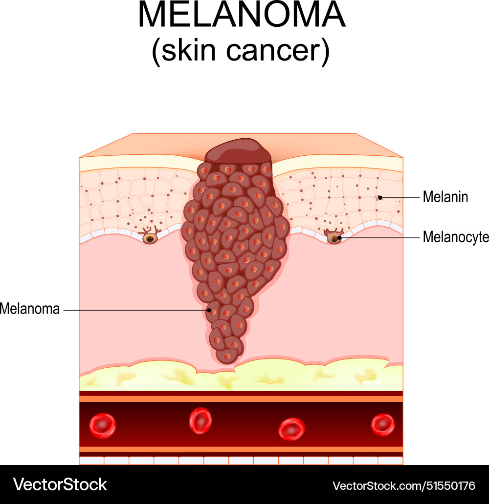 Melanoma skin cancer Royalty Free Vector Image