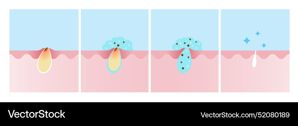 Step of acne pimple treatment process Royalty Free Vector
