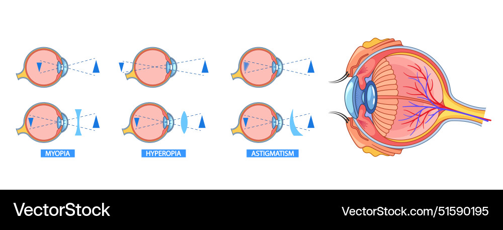 Detailed eye anatomy infographic explaining myopia