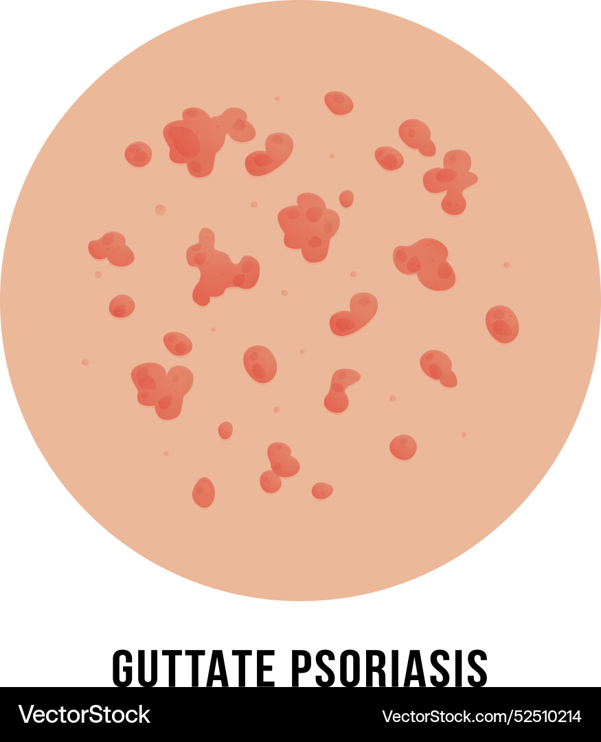 Guttate psoriasis isolated Royalty Free Vector Image