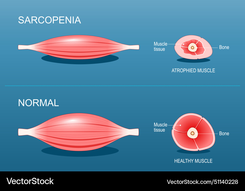 Sarcopenia age-related muscle atrophy Royalty Free Vector