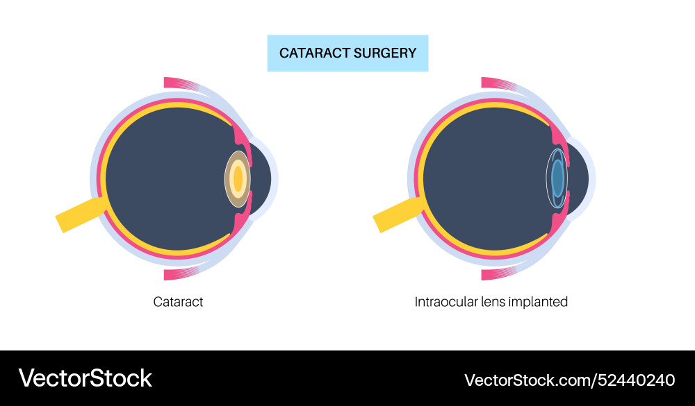 Intraocular lenses poster Royalty Free Vector Image