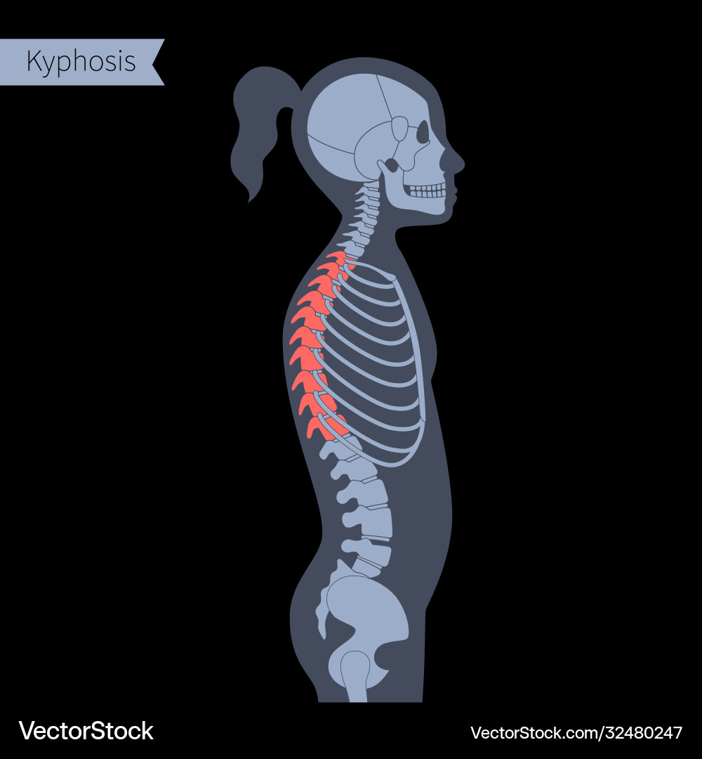 Child Kyphosis X-Ray Royalty Free Vector Image