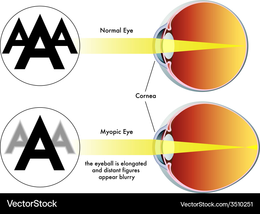Myopia Royalty Free Vector Image - VectorStock