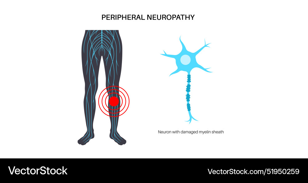 Peripheral neuropathy medical poster Royalty Free Vector