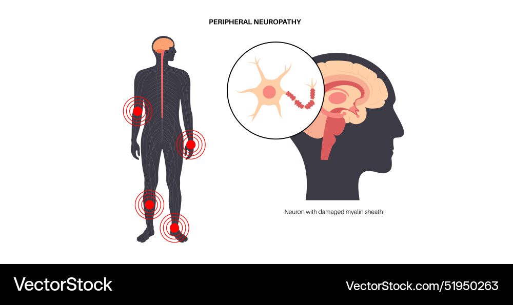 Peripheral neuropathy medical poster Royalty Free Vector