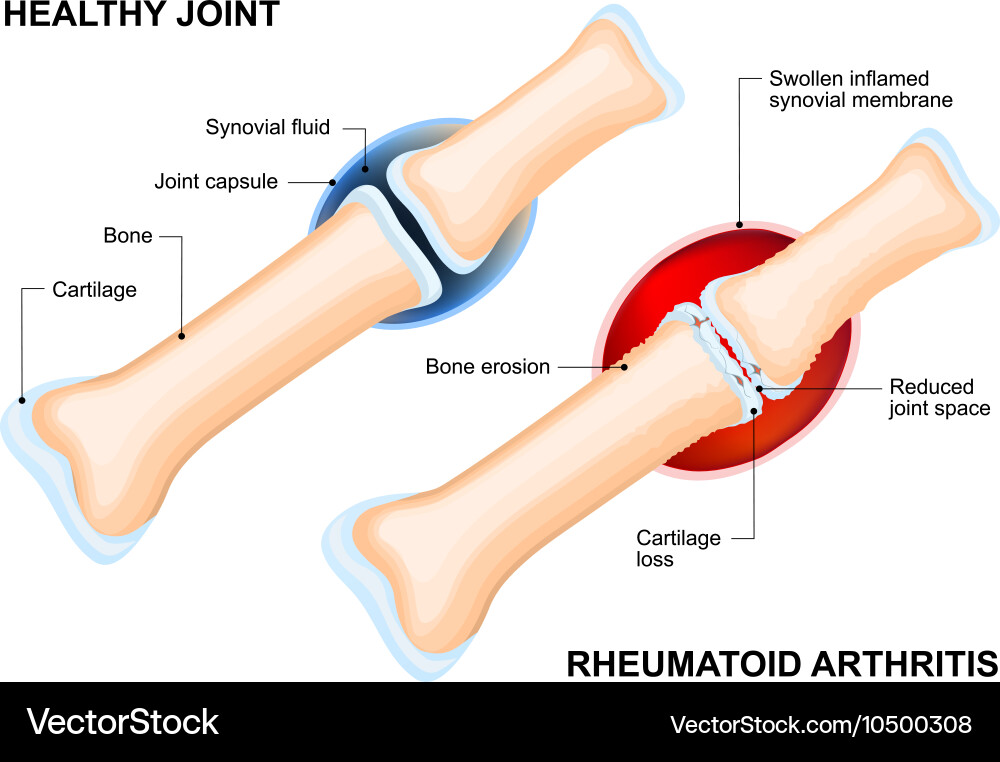 Rheumatoid arthritis Royalty Free Vector Image