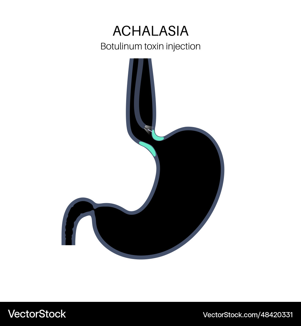 Esophageal botulinum toxin injection Royalty Free Vector
