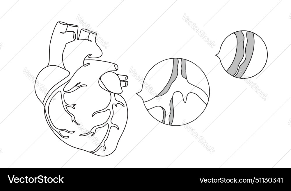 Cardiac ischemia Royalty Free Vector Image - VectorStock