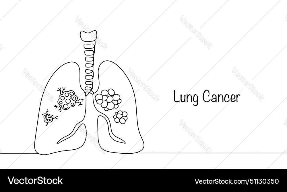 Lung cancer Royalty Free Vector Image - VectorStock