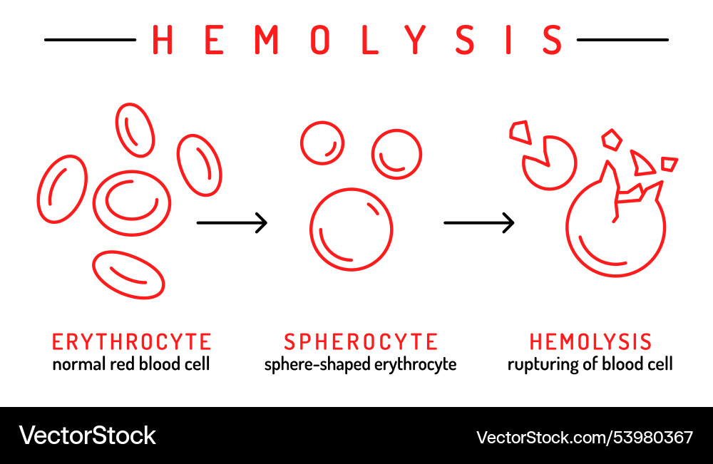 Hemolytic anemia infographic Royalty Free Vector Image