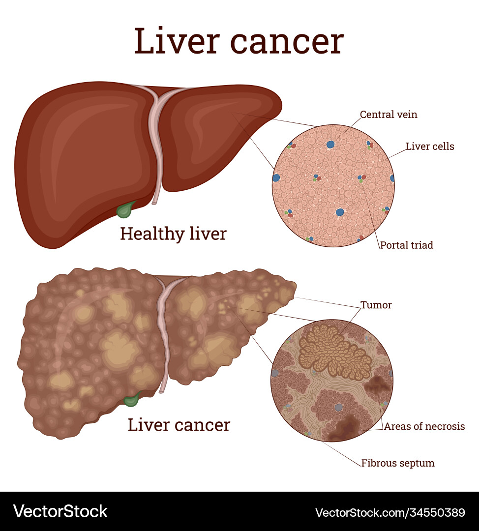 Liver cancer Royalty Free Vector Image - VectorStock