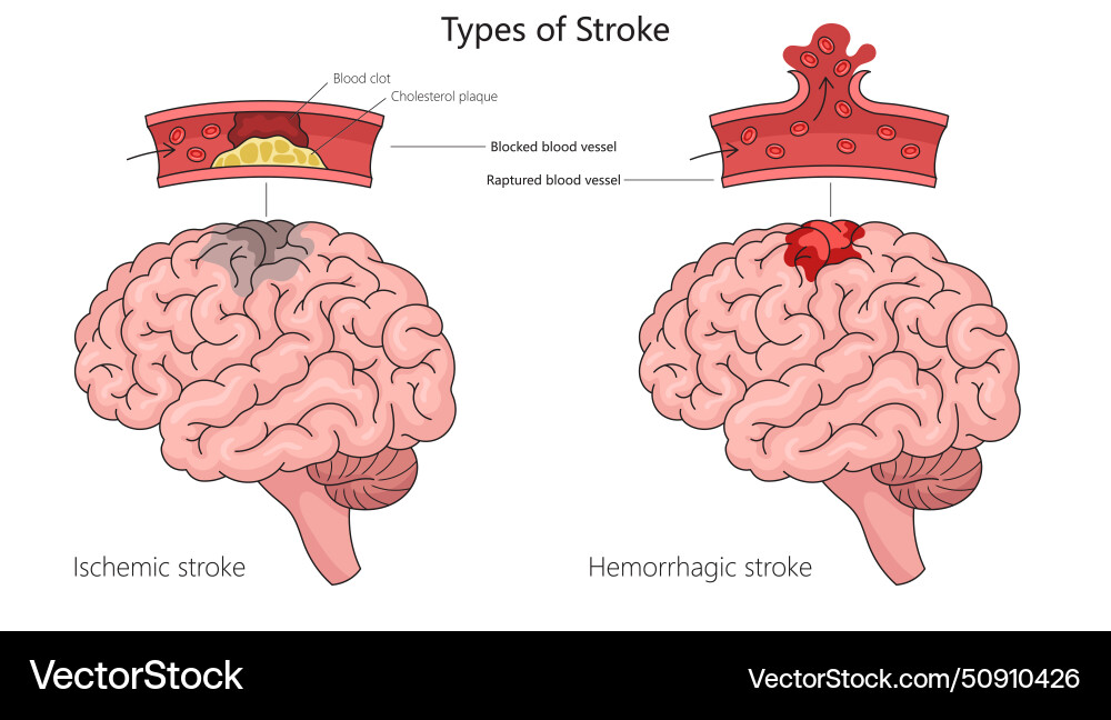 Ischemic And Hemorrhagic Stroke Diagram Medical Vector Image