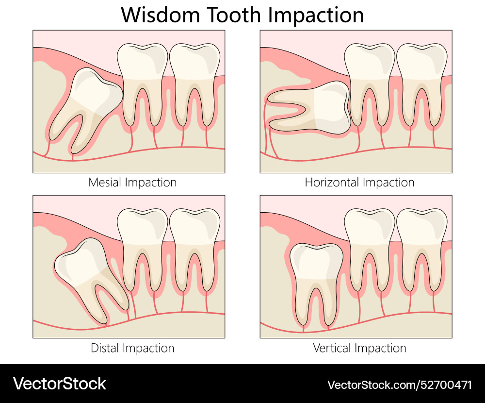 Wisdom Teeth Diagram