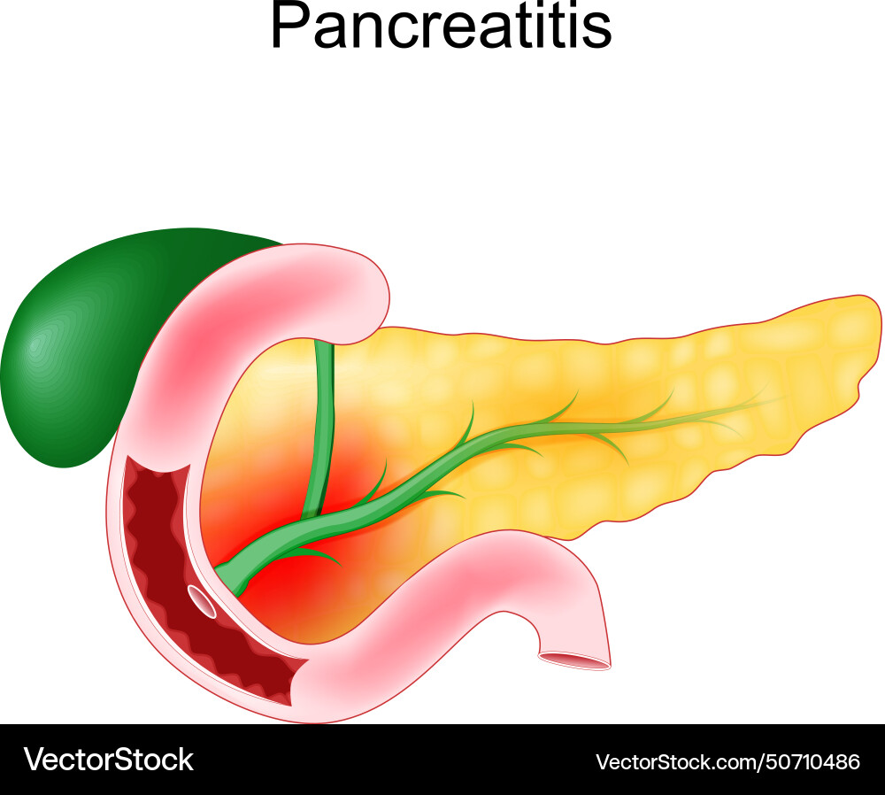 Acute pancreatitis duodenum gallbladder Royalty Free Vector