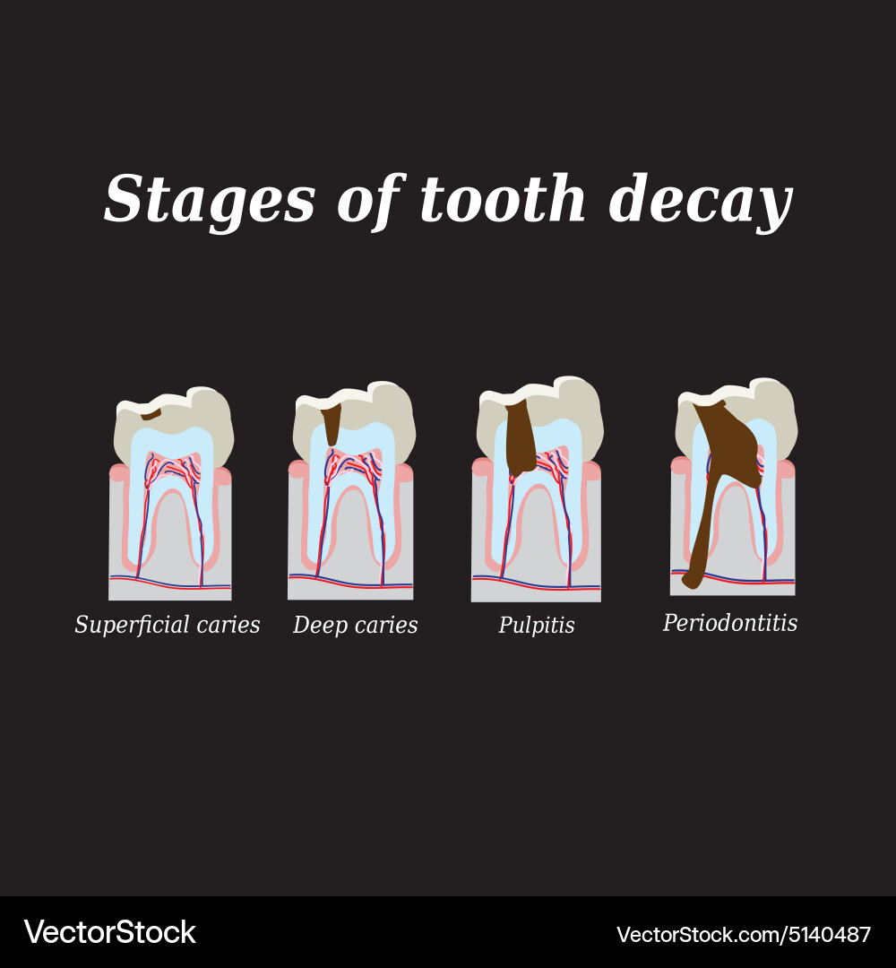 Stages of development dental caries Royalty Free Vector