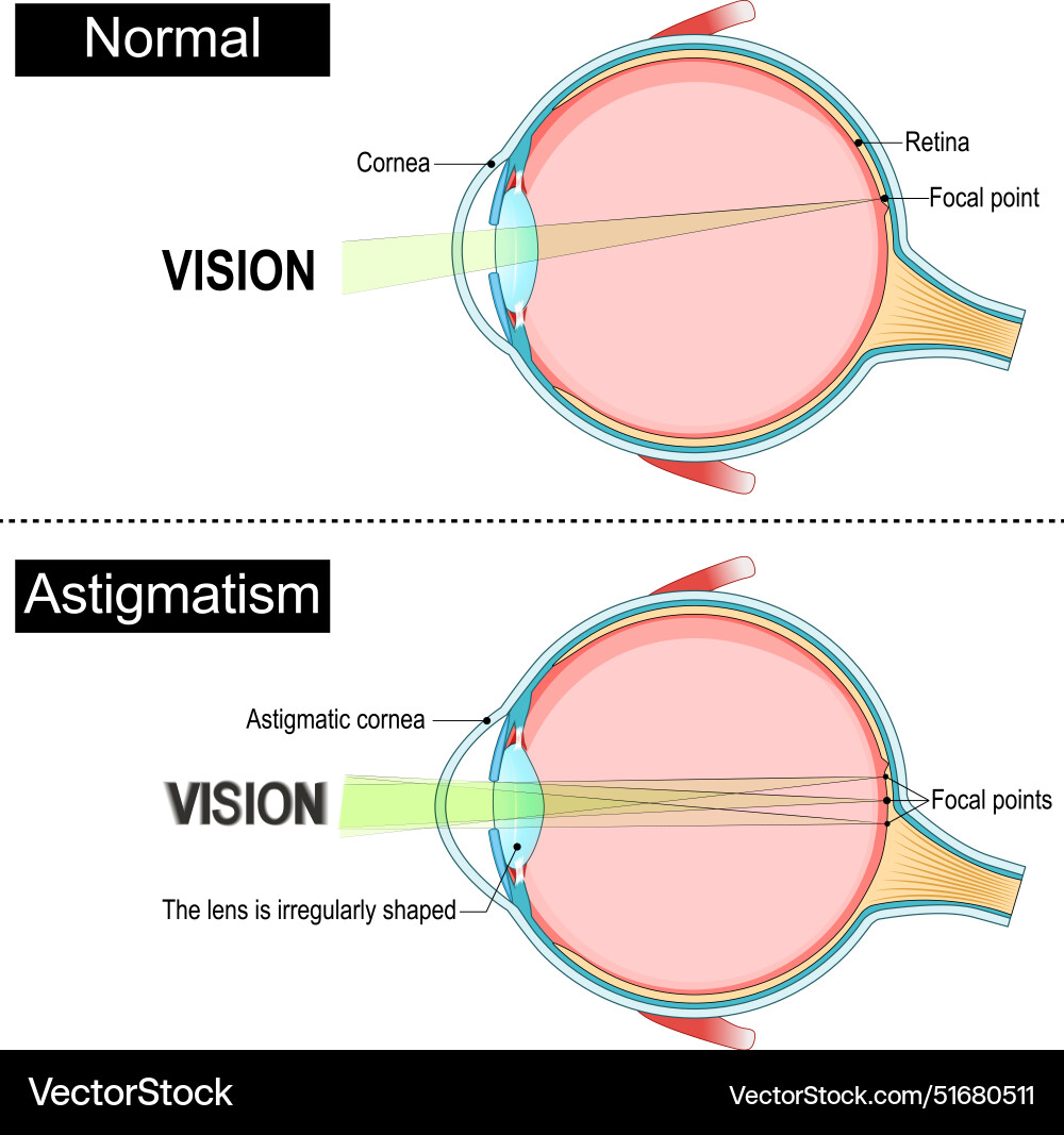 Amblyopia Vector Images (over 120)