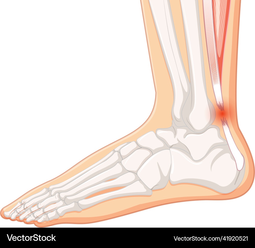 Achilles tendo rupture on white background Vector Image