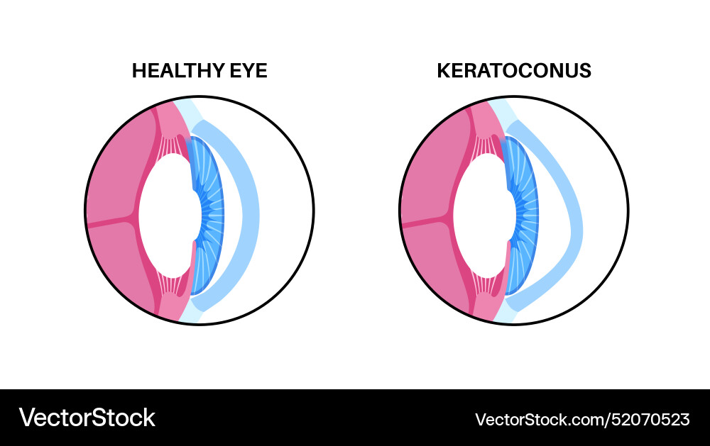 Cataract eye disease Royalty Free Vector Image