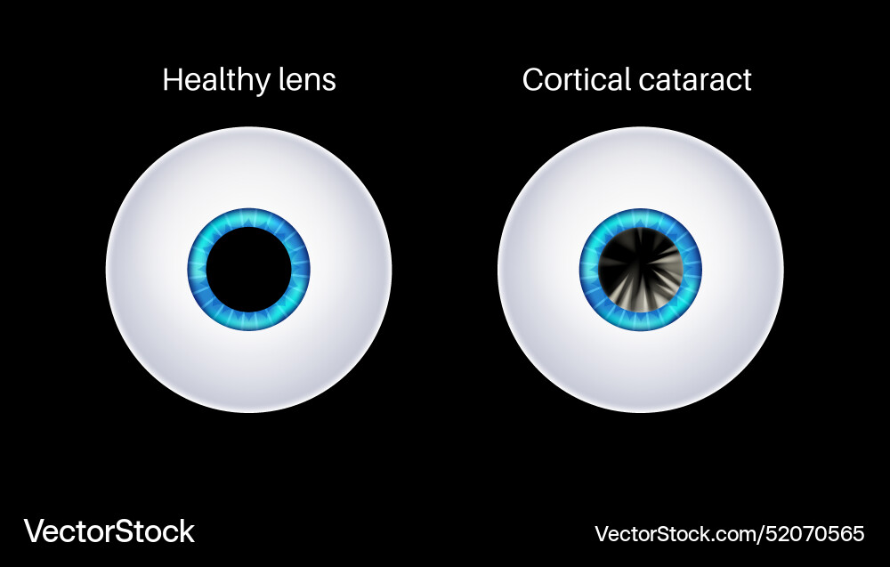 Cataract eye disease Royalty Free Vector Image