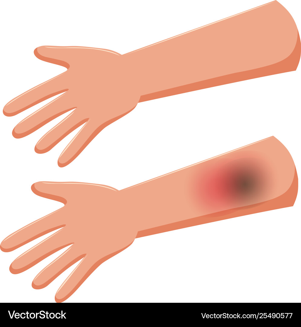 Eine menschliche Hand mit blauem Fleck Lizenzfreier Vektor