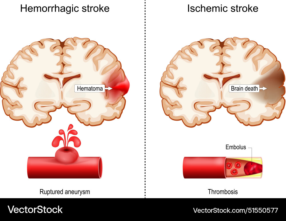 Hemorrhagic and ischemic strokes Royalty Free Vector Image