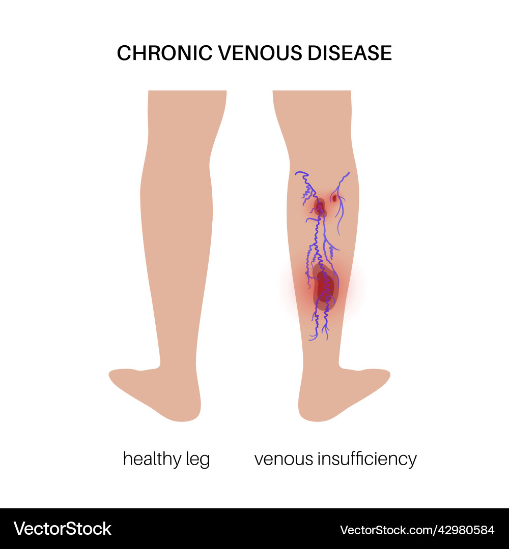 Varicose veins treatment Royalty Free Vector Image