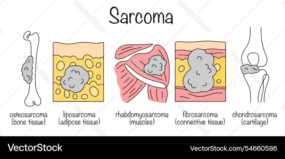 Sarcoma Royalty Free Vector Image - VectorStock