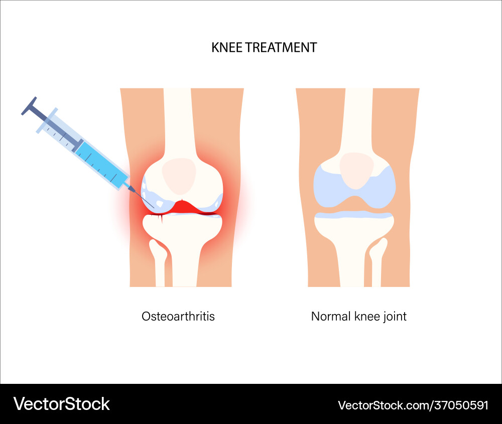 Knee injection concept Royalty Free Vector Image