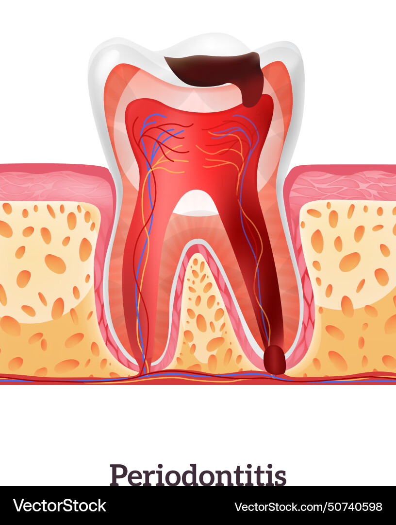 Periodontitis realistic Royalty Free Vector Image