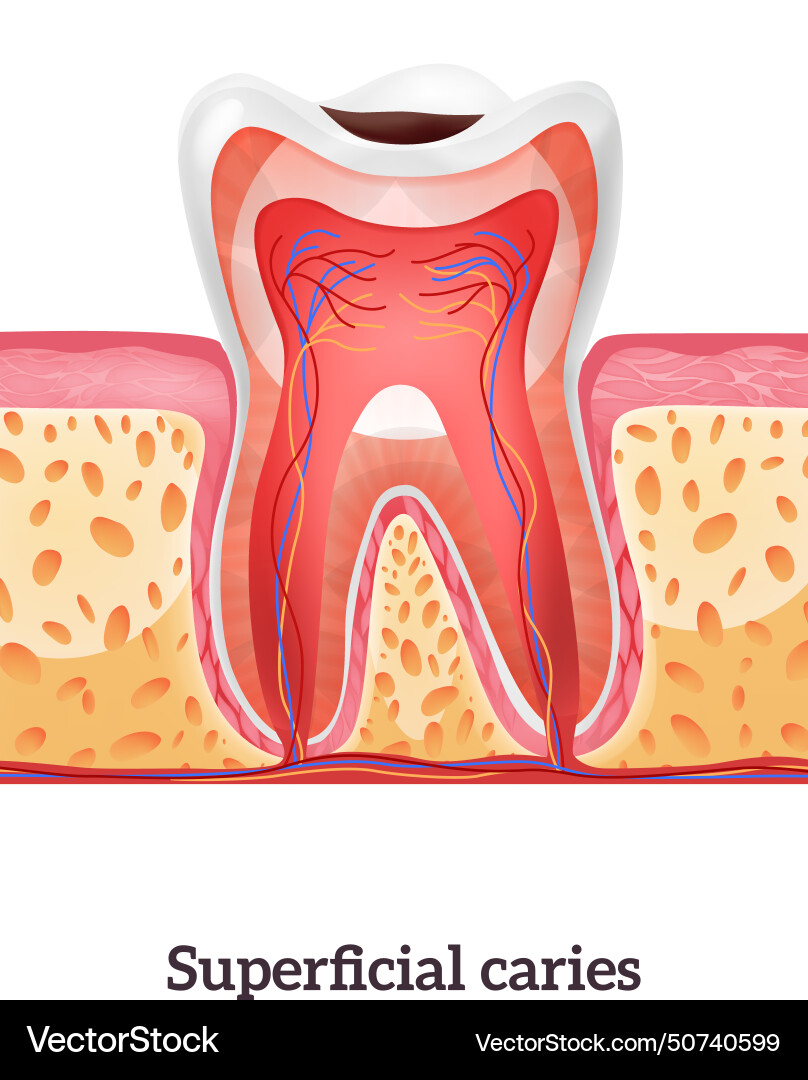 Caries tooth anatomy Royalty Free Vector Image