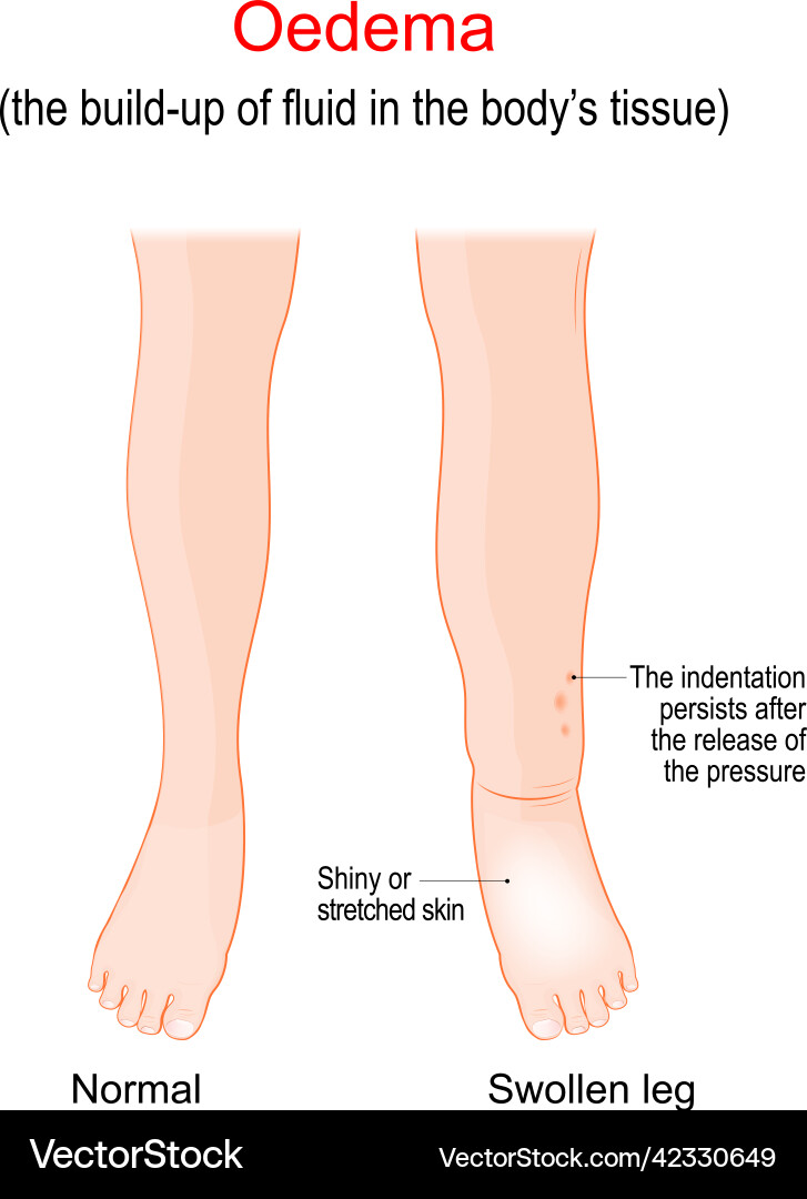 Edema swollen ankles feet and legs oedema Vector Image