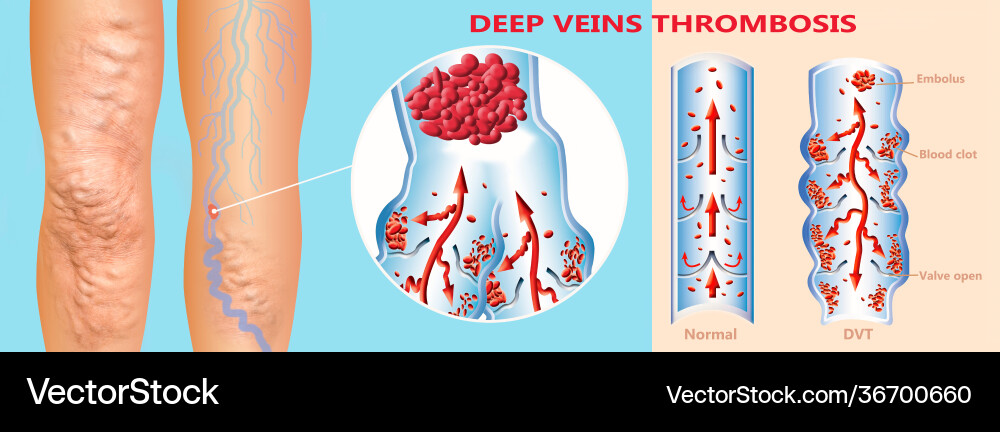 Deep Vein Thrombosis (DVT) Anatomy Royalty Free Vector Image